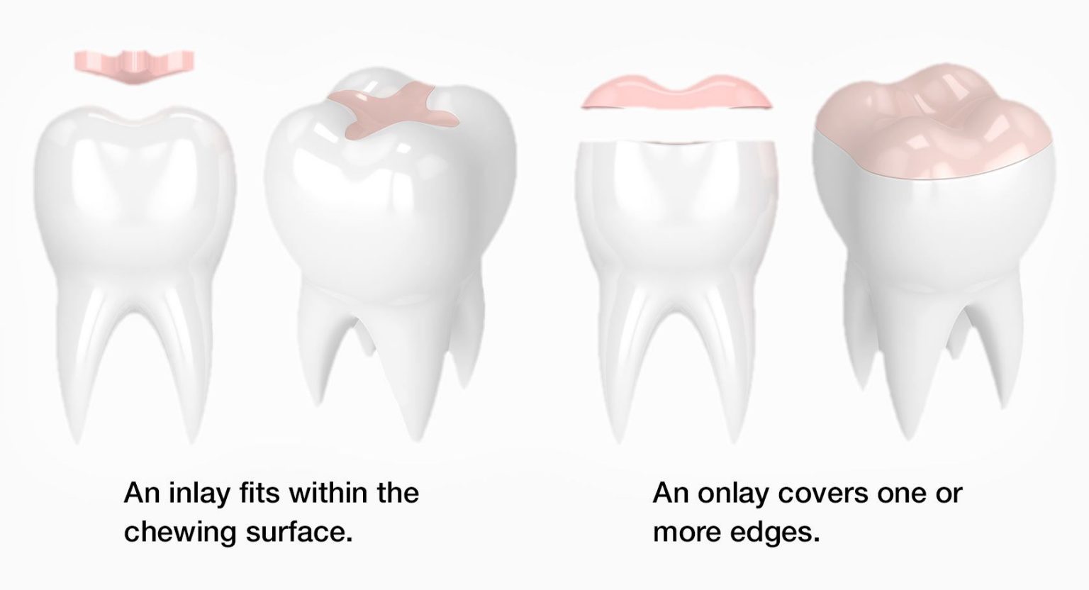 Inlays vs Onlays Tucson | Schumer Dental, PC