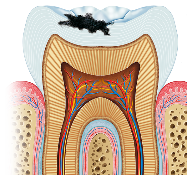 Cavity Fillings Tucson | Schumer Dental, PC