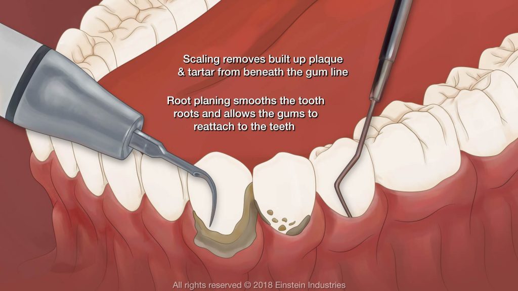 Gingivitis Tucson | Schumer Dental, PC