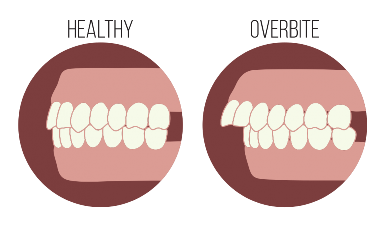 Overbite Tucson | Schumer Dental, PC
