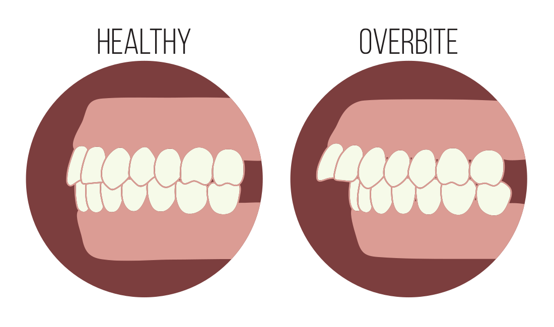Overbite Tucson Schumer Dental PC